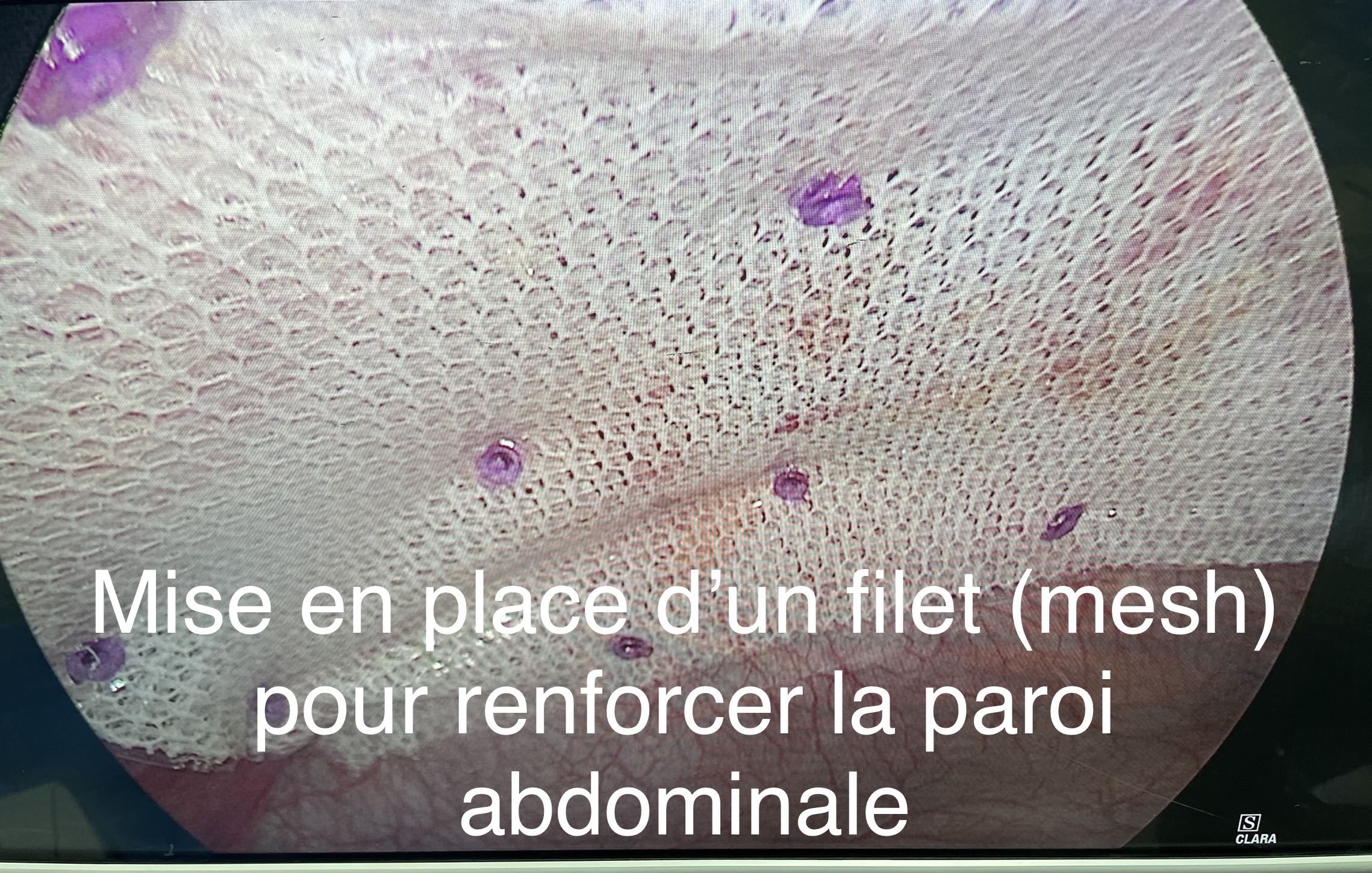 CHIRURGIE DE LA HERNIE - PARIS | FRANCE | CHIRURGIE DIGESTIVE PARIS